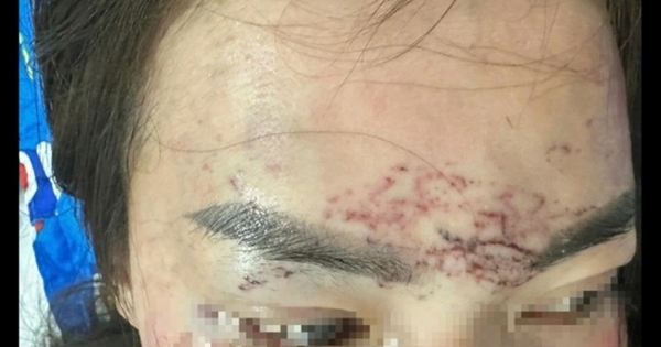 Thông tin mới nhất vụ đánh ghen, đổ axit, xăm mặt ở Cà Mau