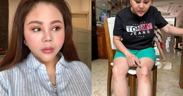 Lê Giang ngừng đóng phim vì có dấu hiệu teo cơ chân do thoát vị đĩa đệm